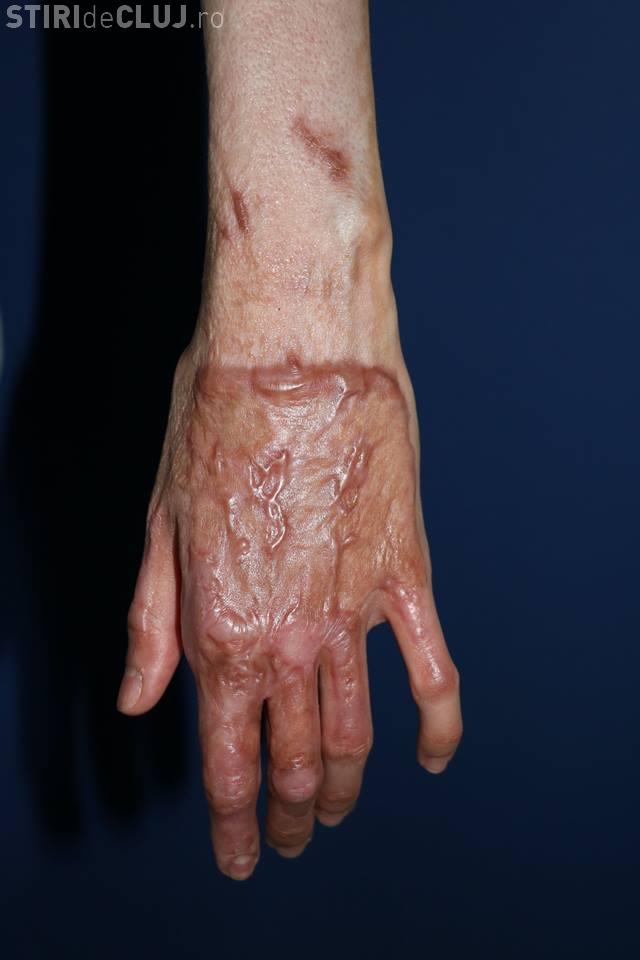 #Colectiv | Alexandra Furnea a povestit CALVARUL prin care a trecut ...